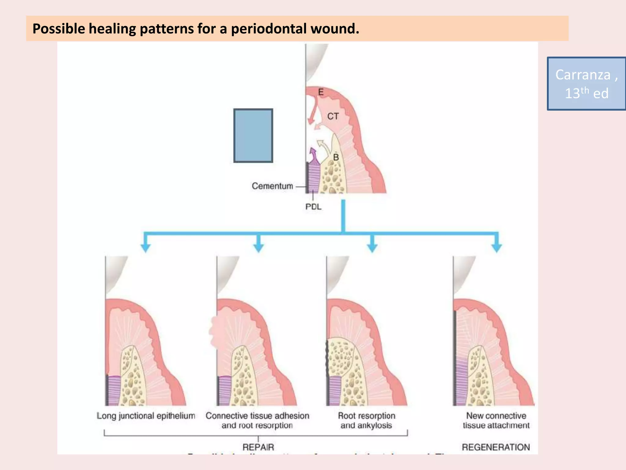 Reconstructive periodontal surgery (part1+2+3) | PPTX