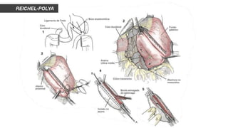 RECONSTRUÇÕES GASTRICAS PÓS GASTRECTOMIA.pptx