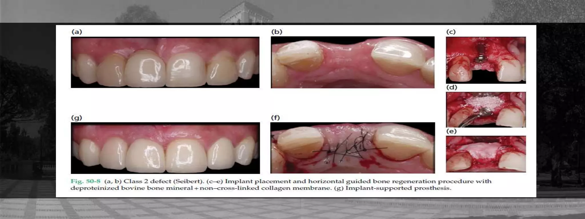 Ridge Augmentation Procedures | PPTX