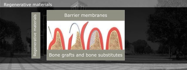 Ridge Augmentation Procedures | PPTX
