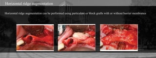 Ridge Augmentation Procedures | PPTX