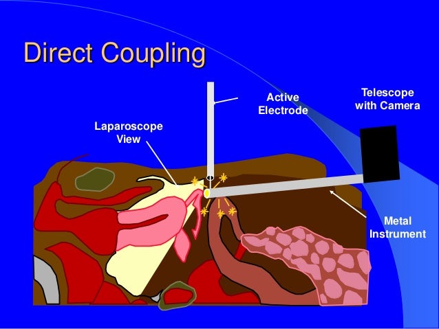 Electro surgery in laparoscopy