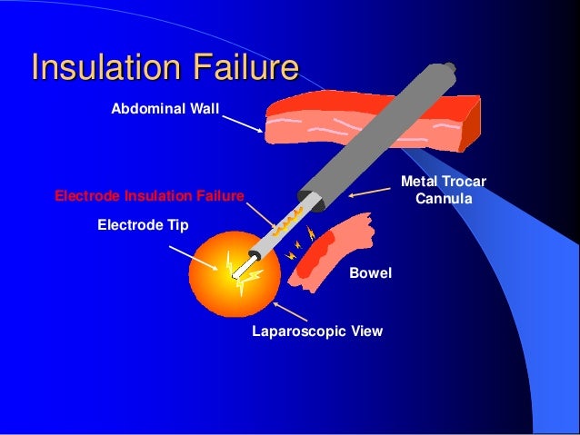 Electro surgery in laparoscopy