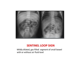 Diagnosis of Acute Pancreatitis | PPT