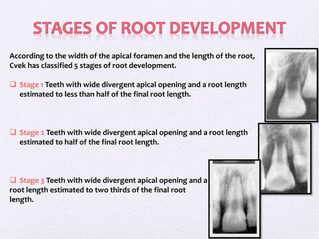 pulp therapy in young permanent tooth | PPTX | Dental Health | Diseases ...