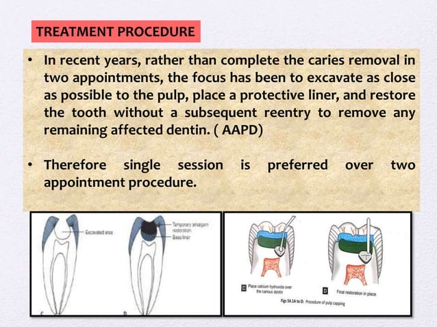 pulp therapy in young permanent tooth | PPTX | Dental Health | Diseases ...