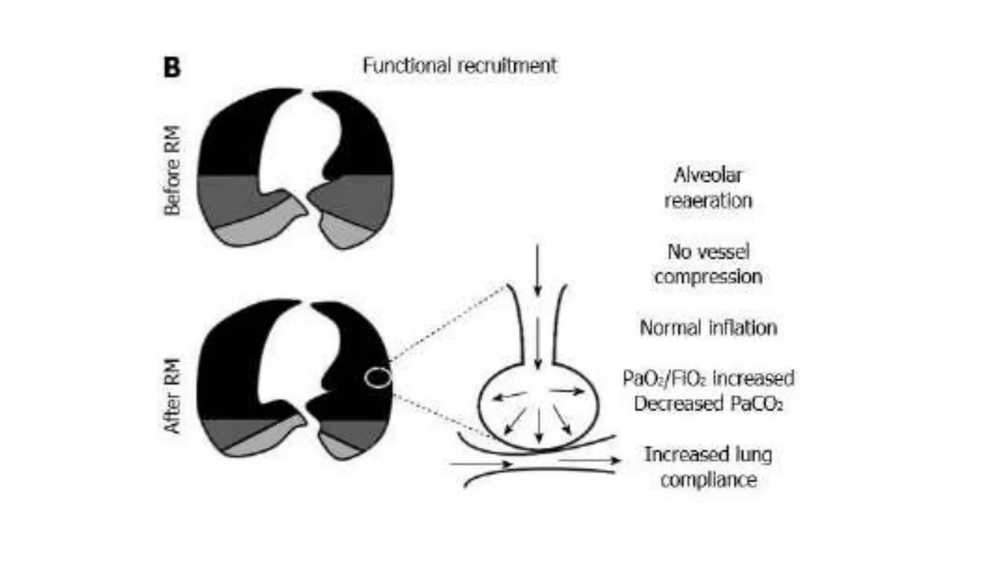 Recruitment maneuvers in ards | PPTX