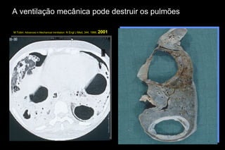 Recrutamento alveolar em anestesia | PPT