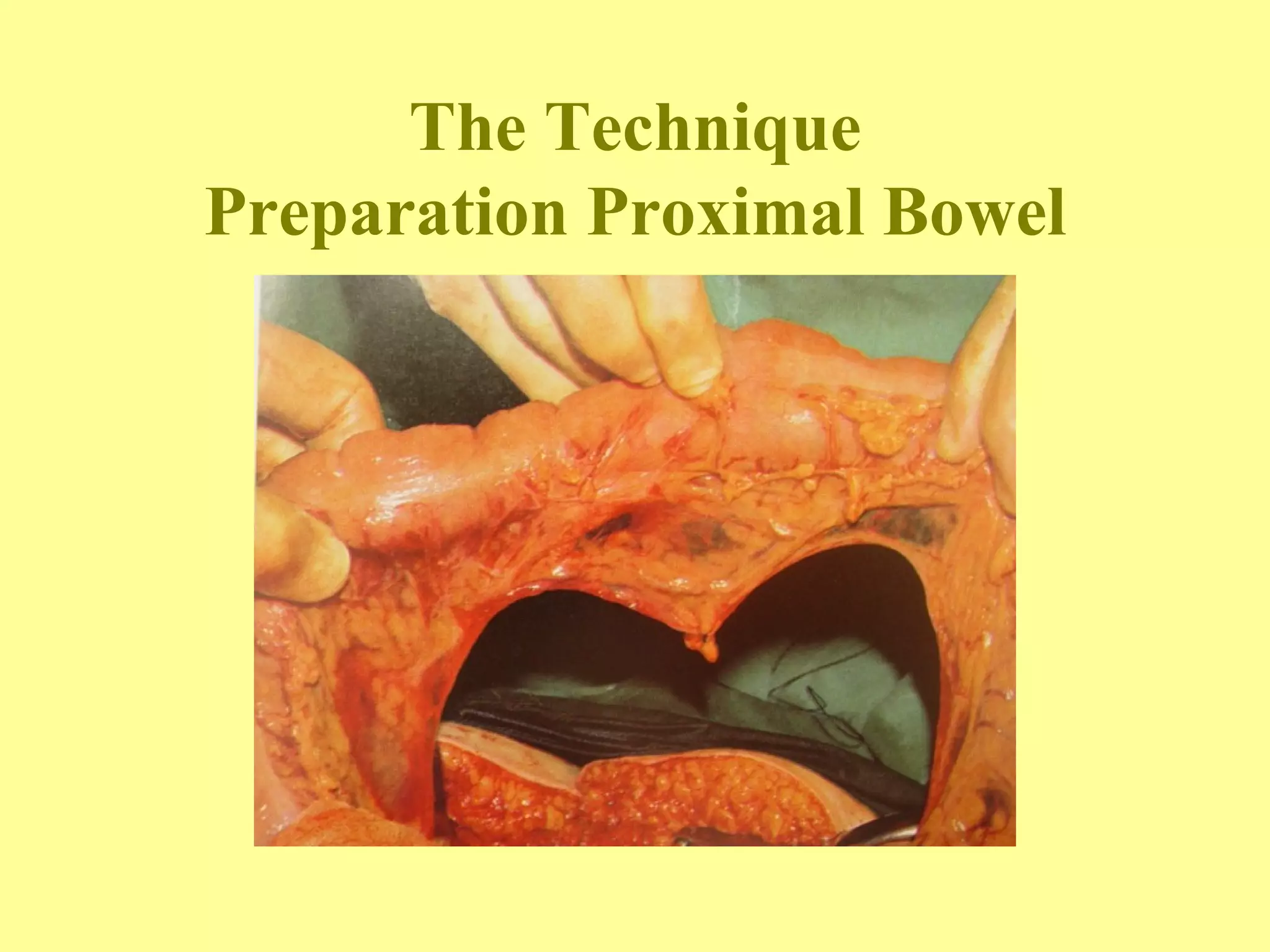 The Surgery for Rectal Cancer | PPT