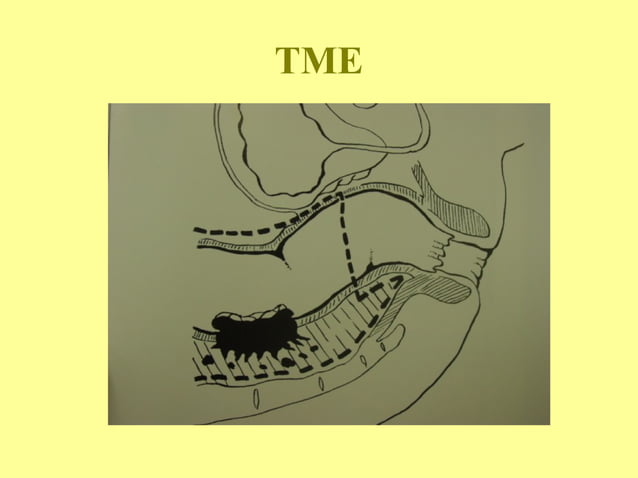 The Surgery for Rectal Cancer