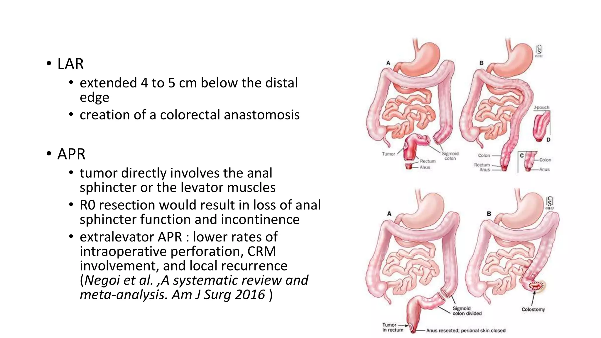 approach for rectal carcinoma and management | PPTX
