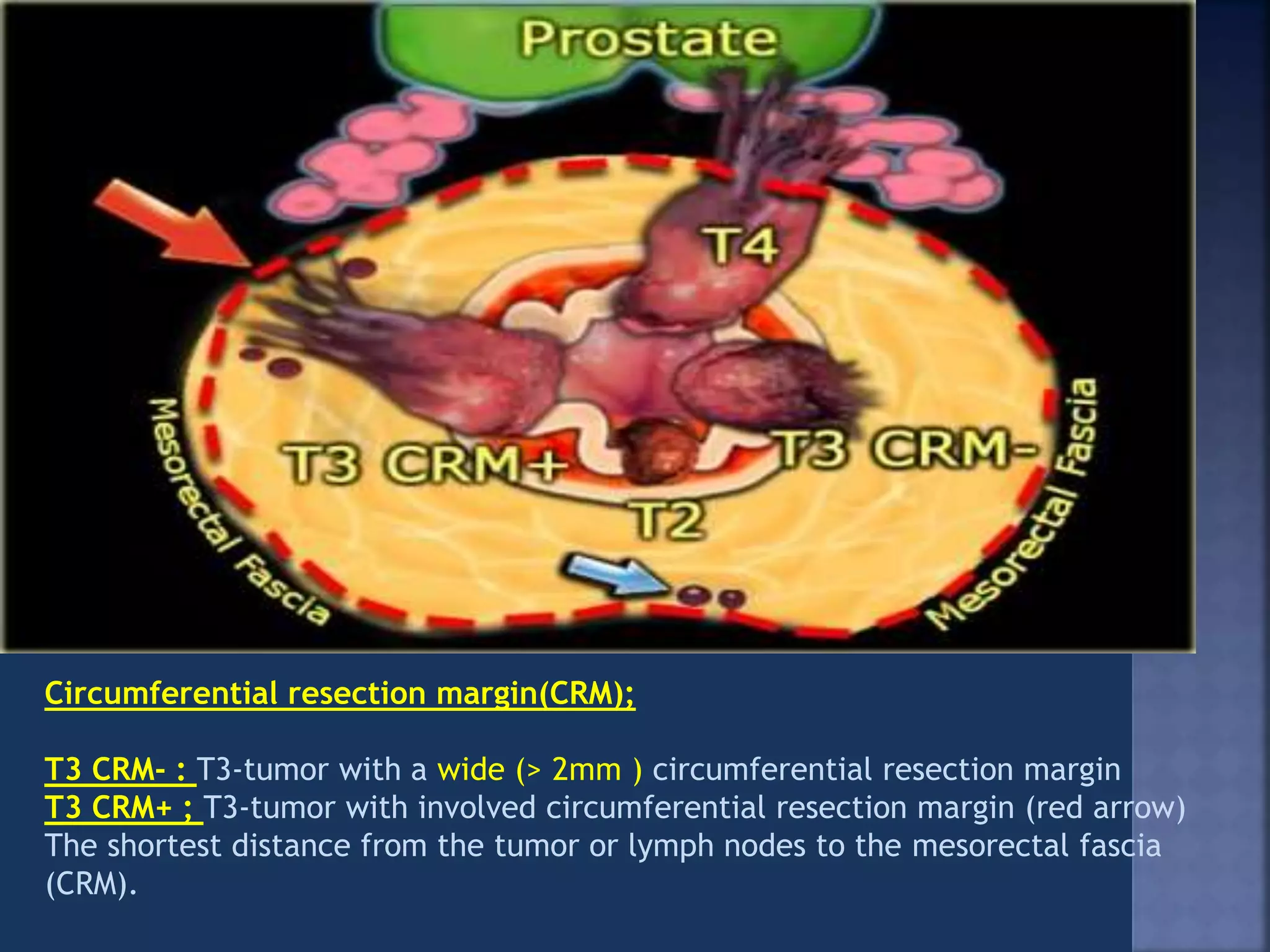 Rectal cancer MRI (for staging of CA rectum), Dr. Adnan Rashid, MD | PPTX