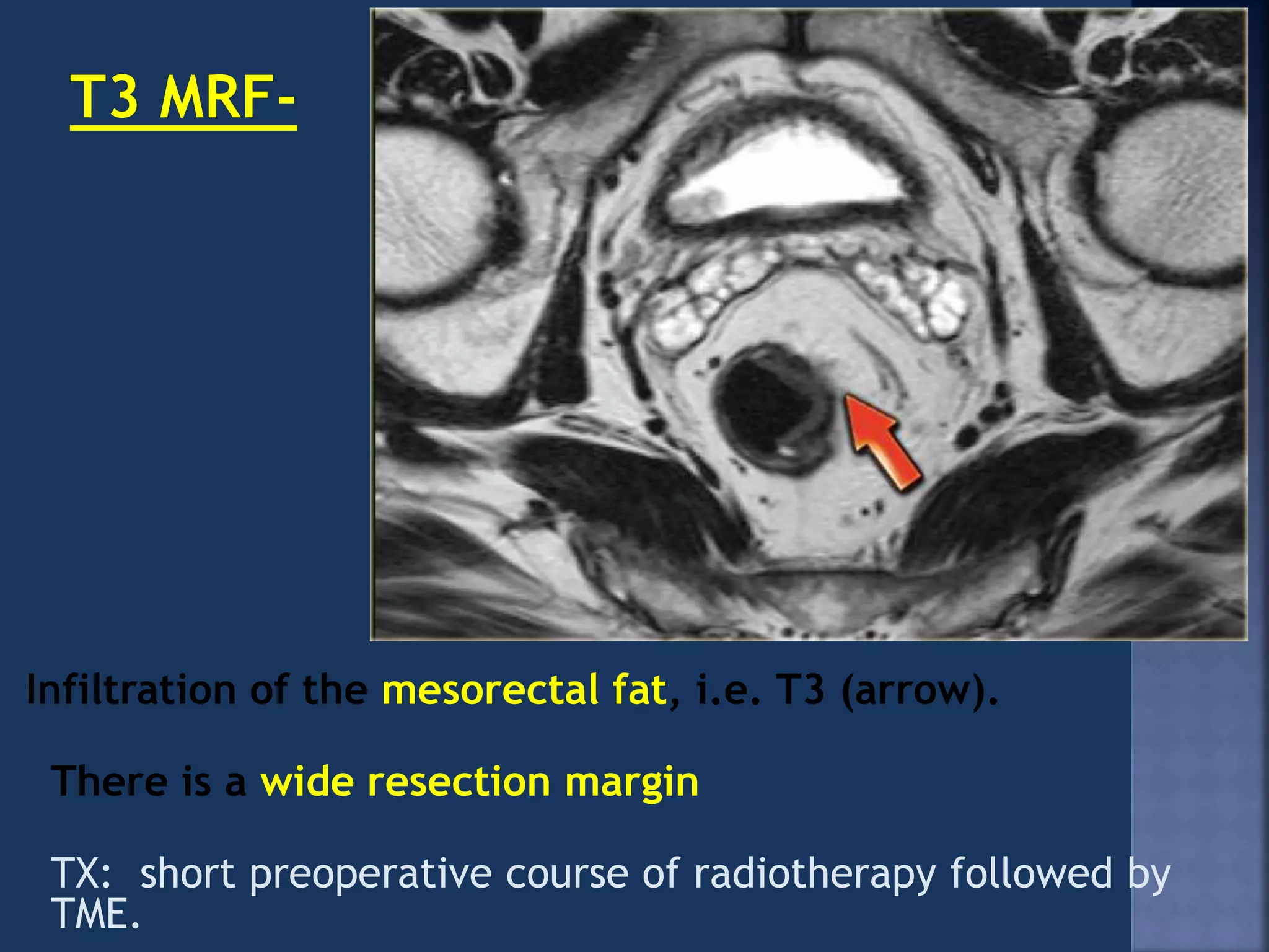 Rectal cancer MRI (for staging of CA rectum), Dr. Adnan Rashid, MD | PPTX