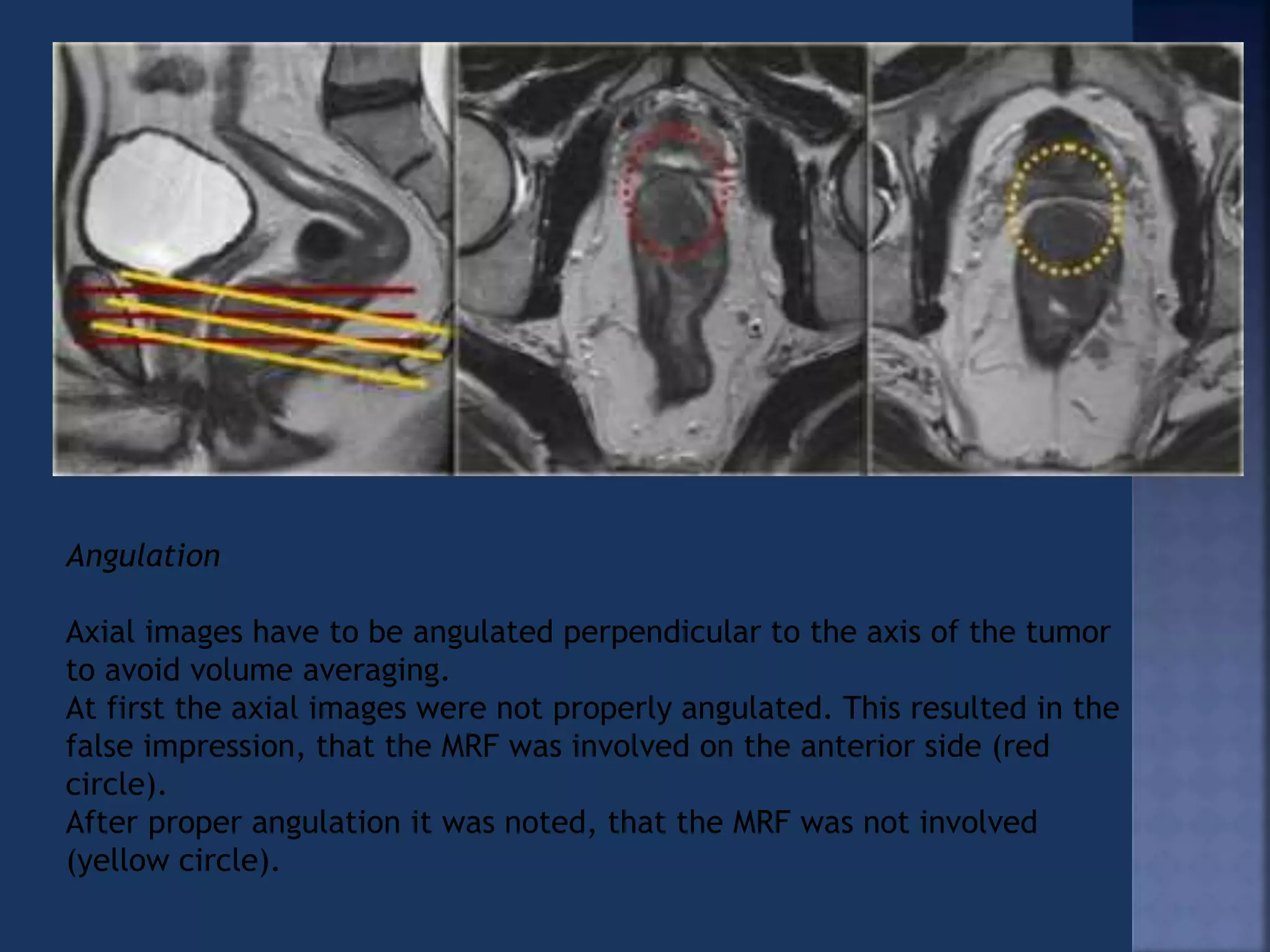 Rectal cancer MRI (for staging of CA rectum), Dr. Adnan Rashid, MD | PPTX