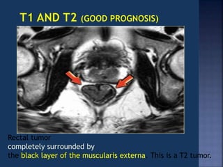 Rectal cancer MRI (for staging of CA rectum), Dr. Adnan Rashid, MD | PPTX