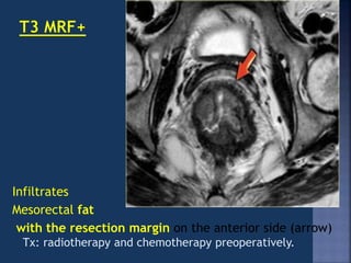 Rectal cancer MRI (for staging of CA rectum), Dr. Adnan Rashid, MD | PPTX