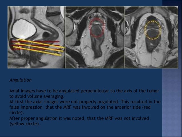 Rectal cancer MRI (for staging of CA rectum), Dr. Adnan Rashid, MD