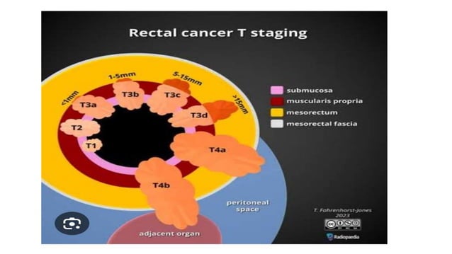 rectal cancer 2024 management guidelines | PPTX