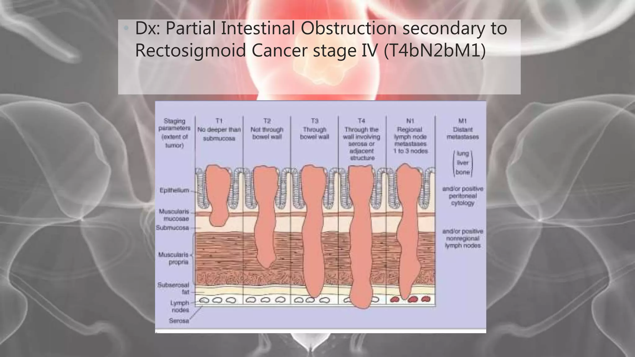 Rectal cancer | PPTX