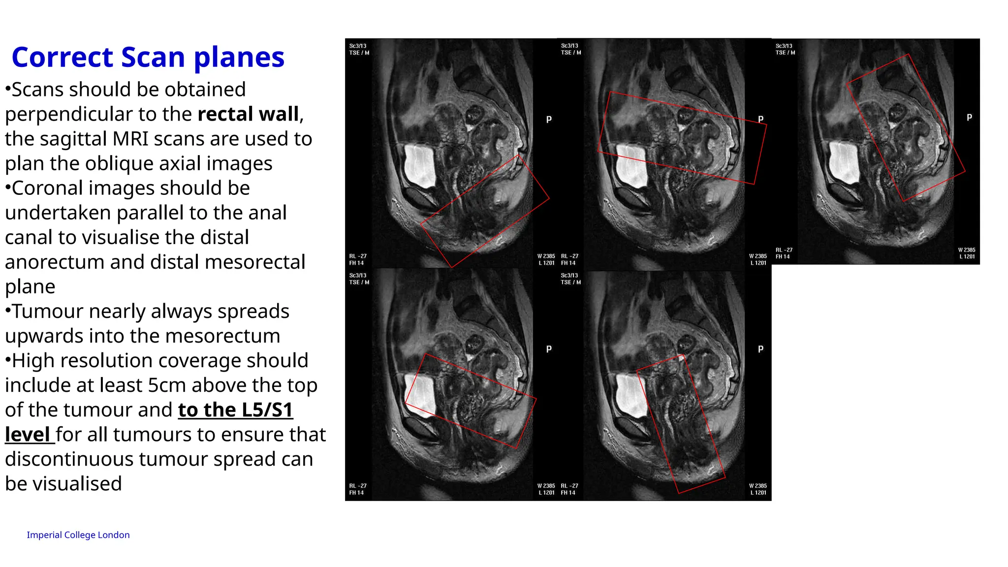 Rectal Cancer High Res MRI_GinaBrown.pptx