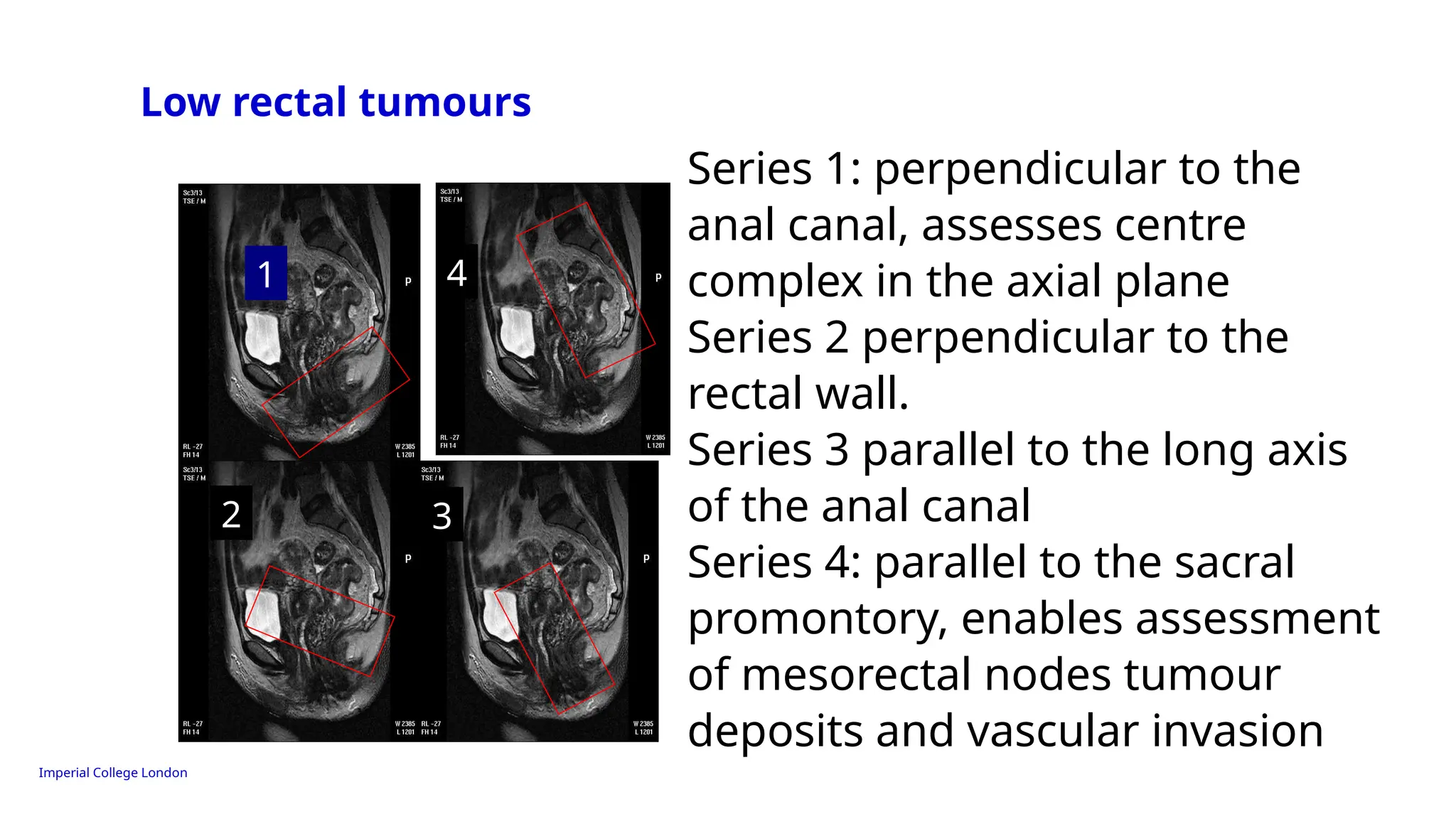 Rectal Cancer High Res MRI_GinaBrown.pptx