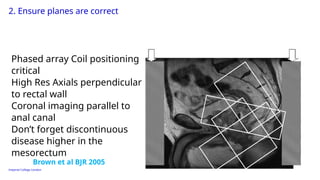 Rectal Cancer High Res MRI_GinaBrown.pptx