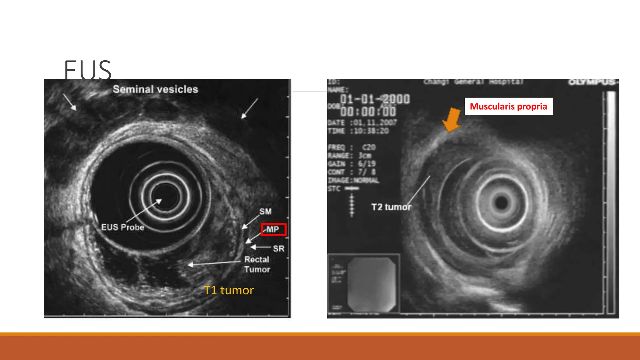 rectal cancer staging;Imaging for rectal cancer staging -Endoscopic ...