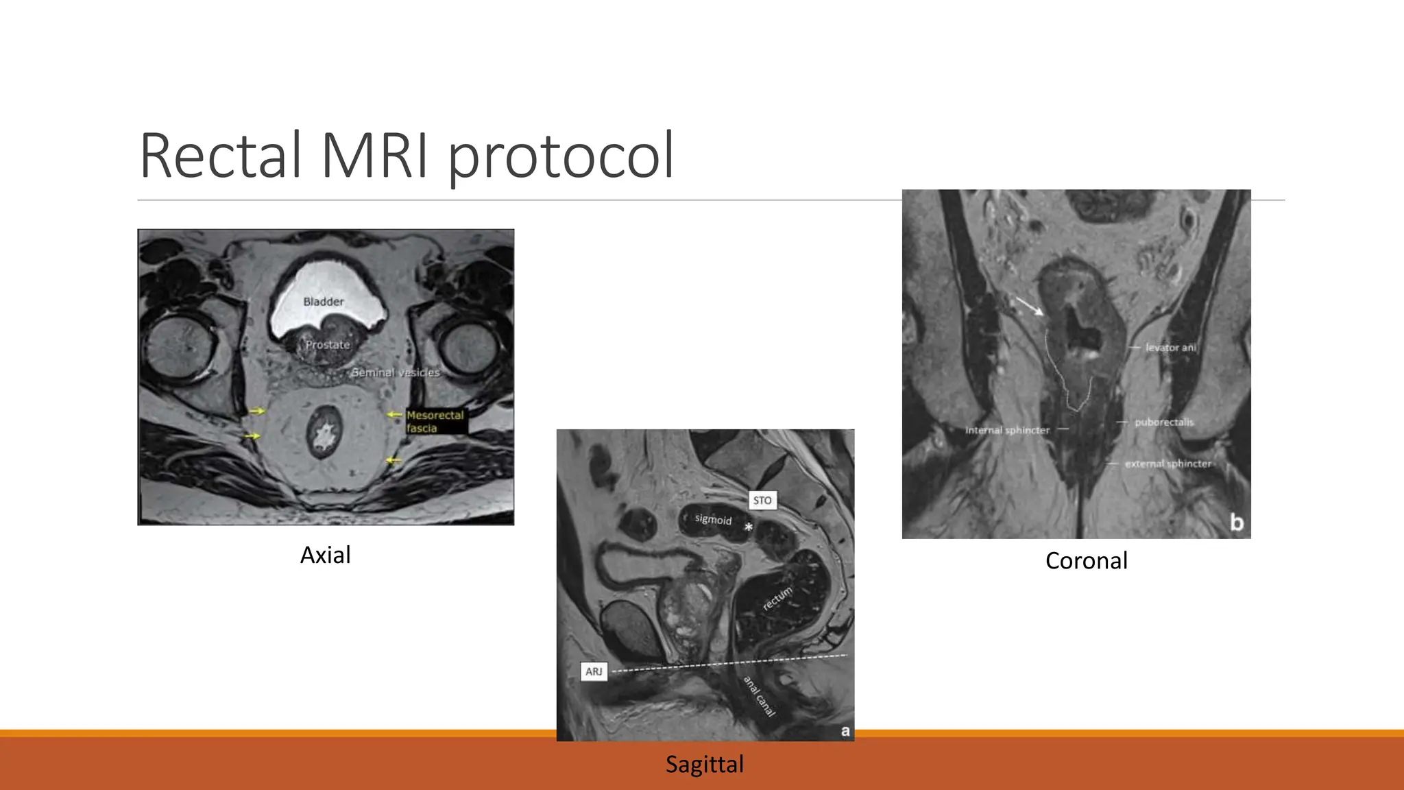 rectal cancer staging;Imaging for rectal cancer staging -Endoscopic ...