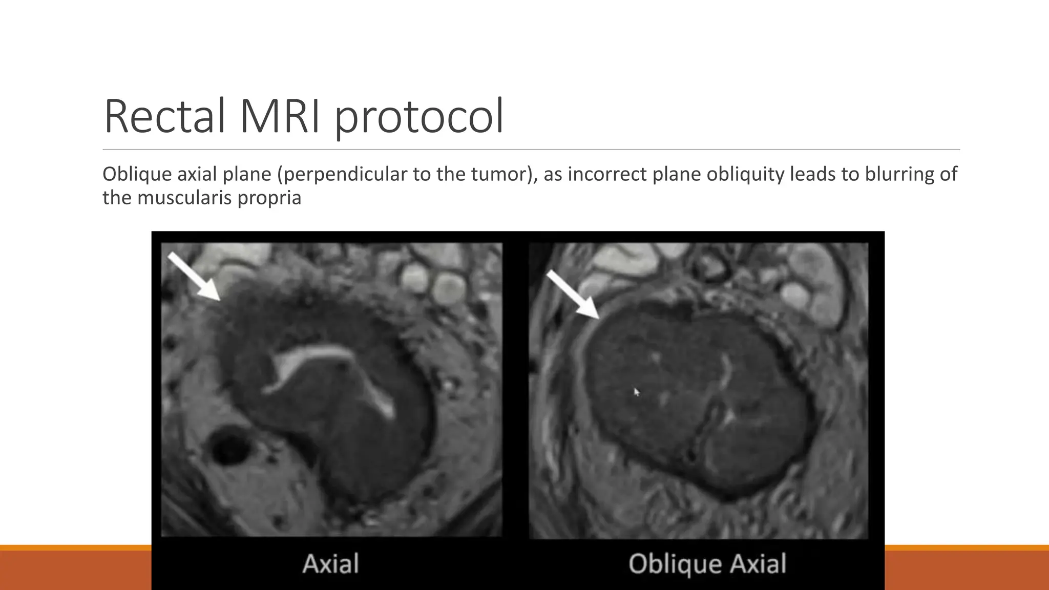 rectal cancer staging;Imaging for rectal cancer staging -Endoscopic ...