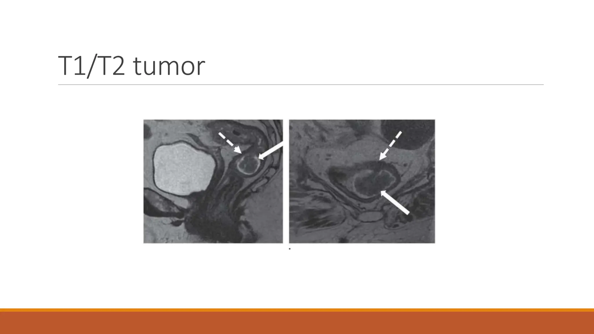 rectal cancer staging;Imaging for rectal cancer staging -Endoscopic ...