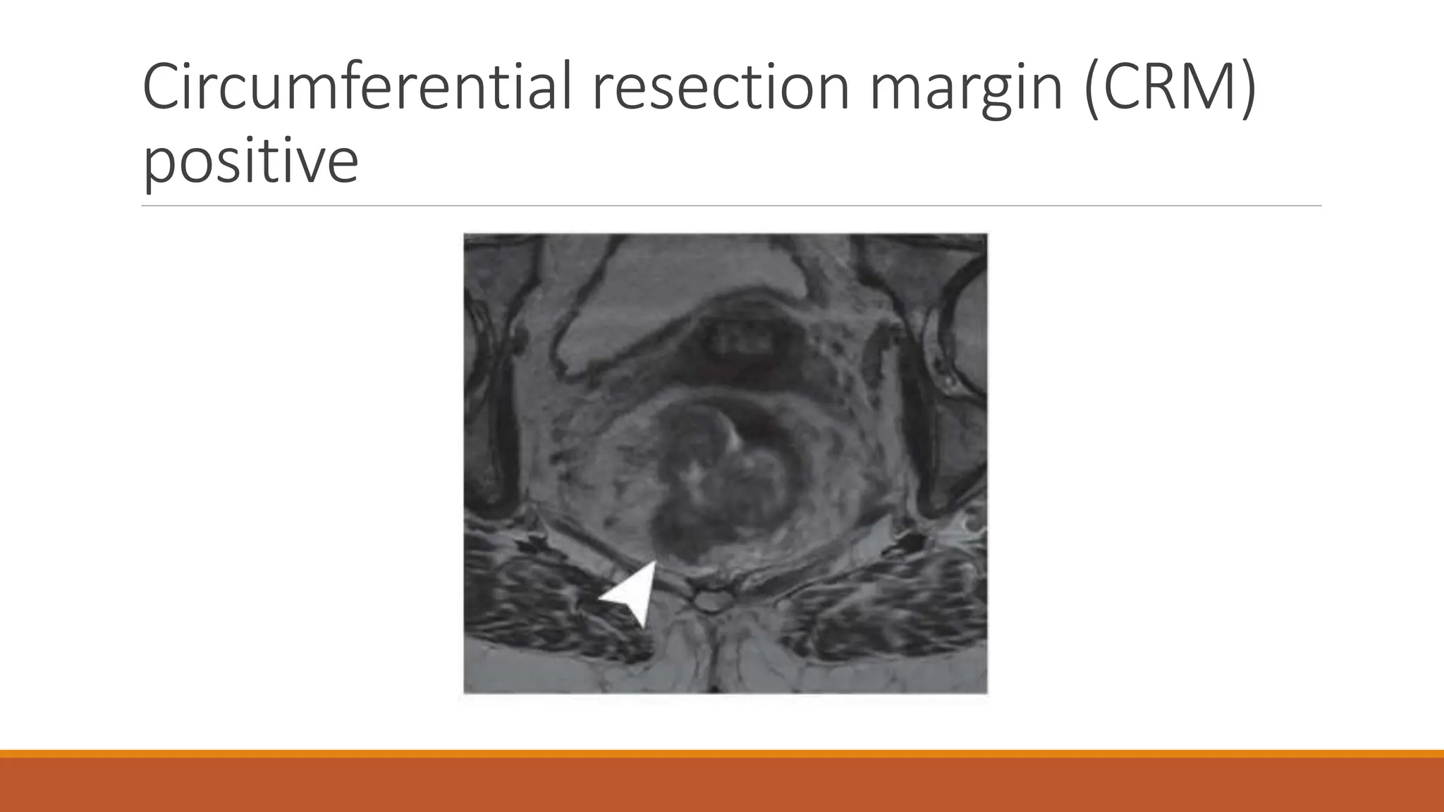rectal cancer staging;Imaging for rectal cancer staging -Endoscopic ...