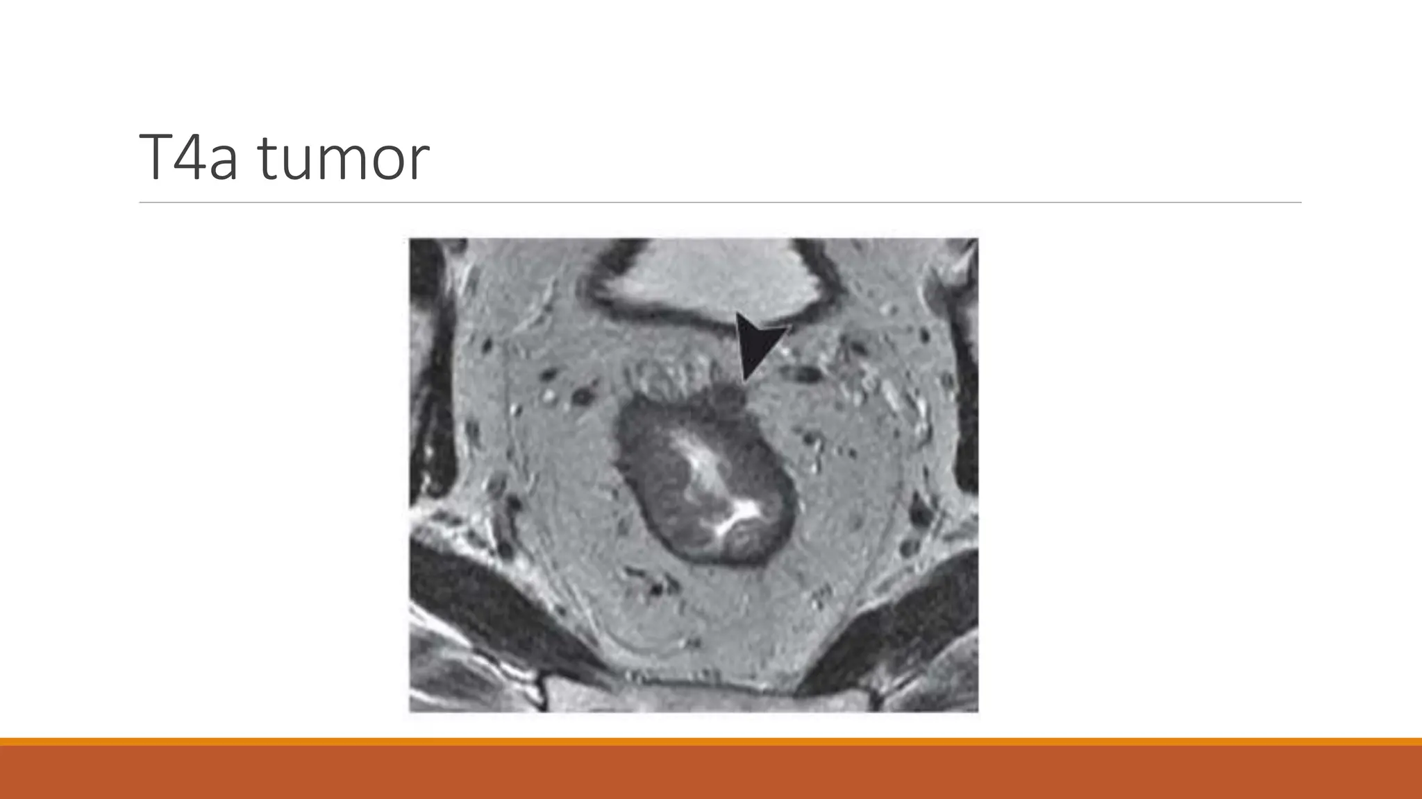 rectal cancer staging;Imaging for rectal cancer staging -Endoscopic ...