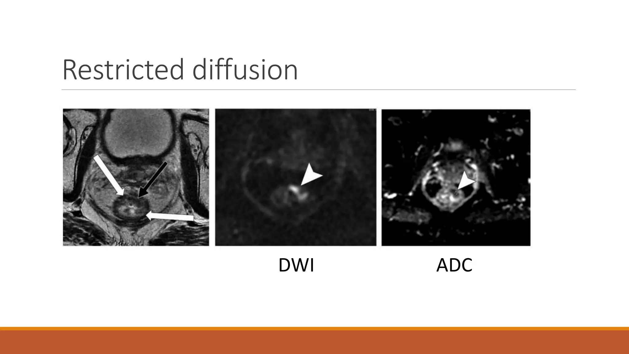 rectal cancer staging;Imaging for rectal cancer staging -Endoscopic ...