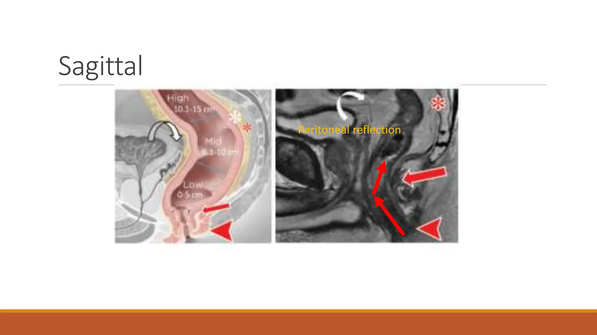 rectal cancer staging;Imaging for rectal cancer staging -Endoscopic ...