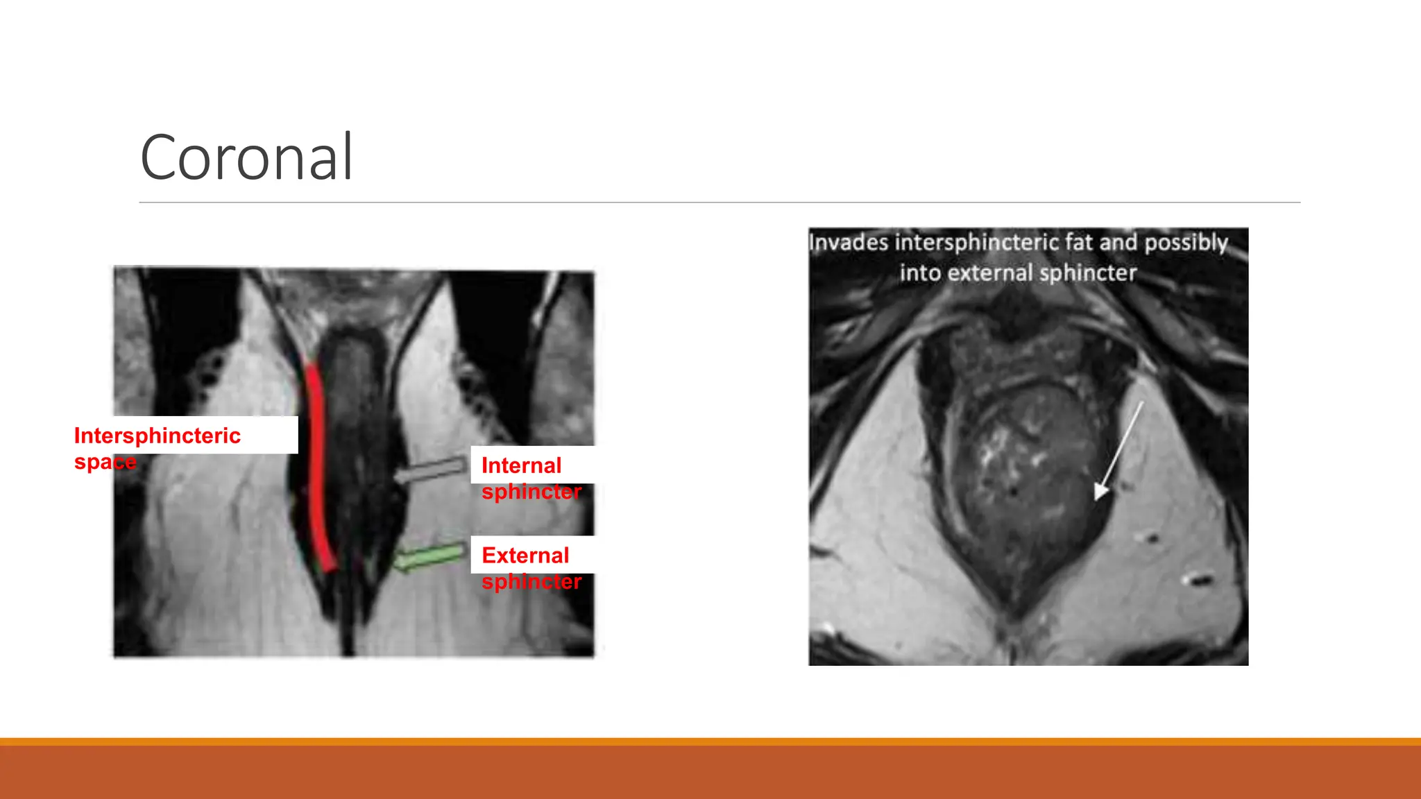 rectal cancer staging;Imaging for rectal cancer staging -Endoscopic ...