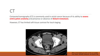 rectal cancer staging;Imaging for rectal cancer staging -Endoscopic ...