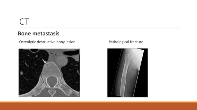 rectal cancer staging;Imaging for rectal cancer staging -Endoscopic ...