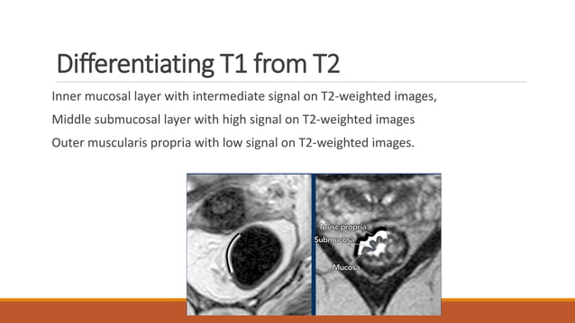 rectal cancer staging;Imaging for rectal cancer staging -Endoscopic ...