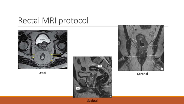 rectal cancer staging;Imaging for rectal cancer staging -Endoscopic ...