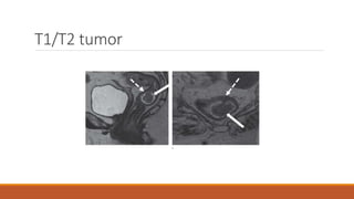 rectal cancer staging;Imaging for rectal cancer staging -Endoscopic ...