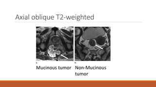 rectal cancer staging;Imaging for rectal cancer staging -Endoscopic ...