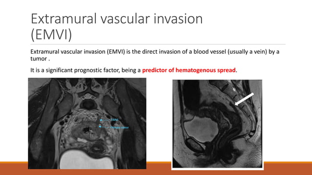 rectal cancer staging;Imaging for rectal cancer staging -Endoscopic ...