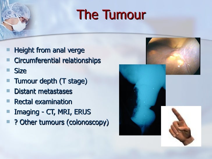 Surgery for Rectal Cancer