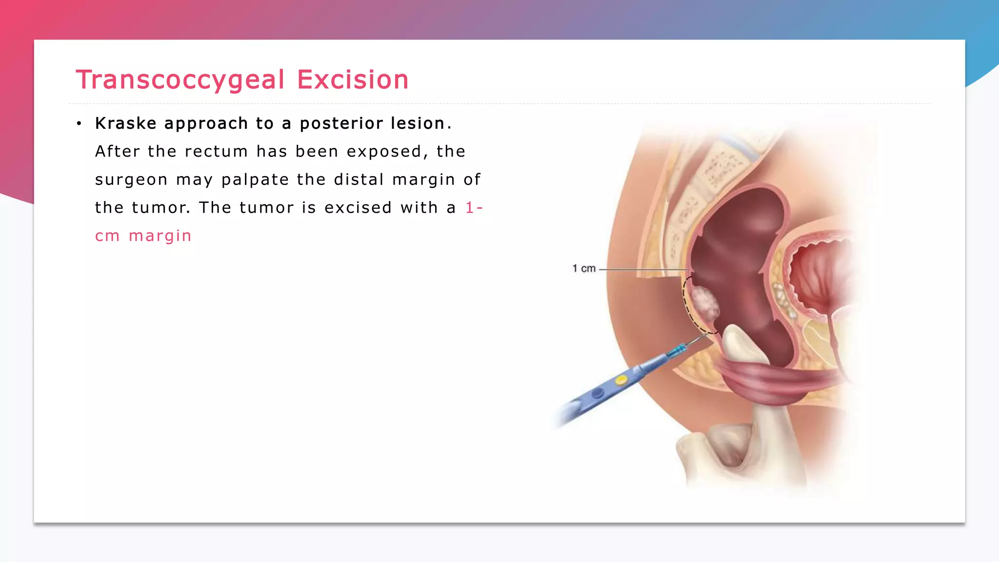 Rectal Carcinoma.pptx