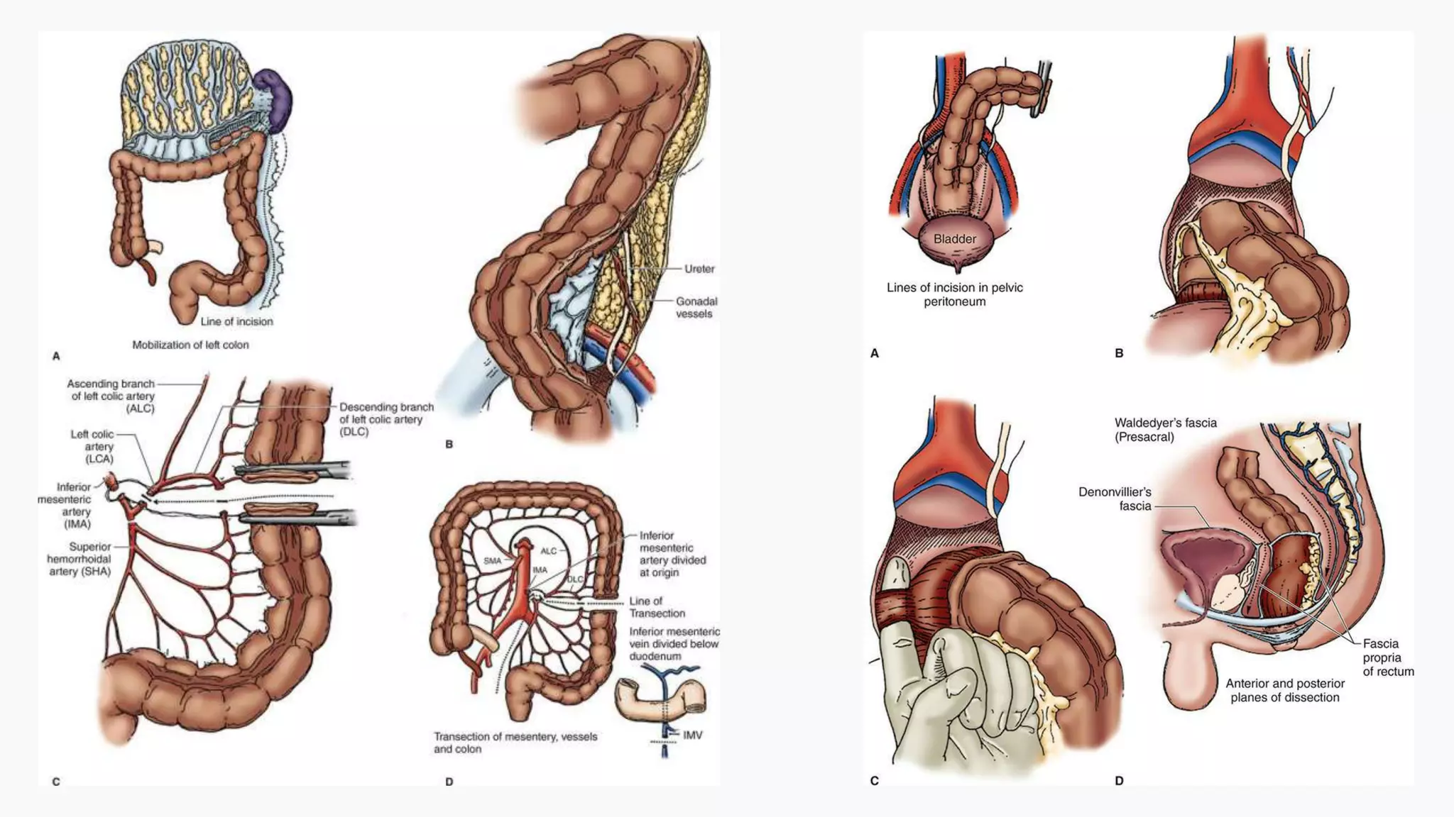 Rectal Carcinoma.pptx