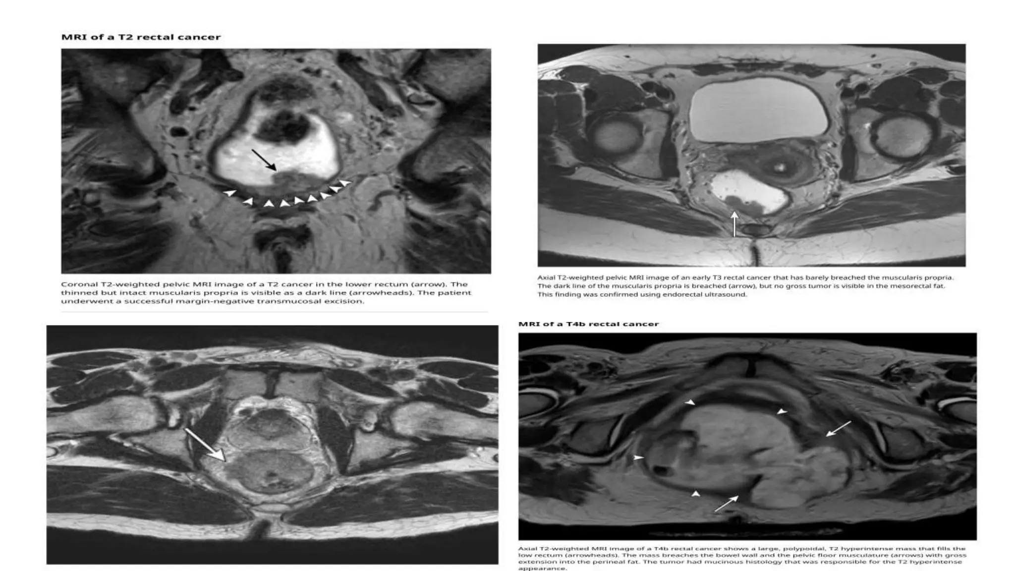 Rectal Carcinoma | PPTX