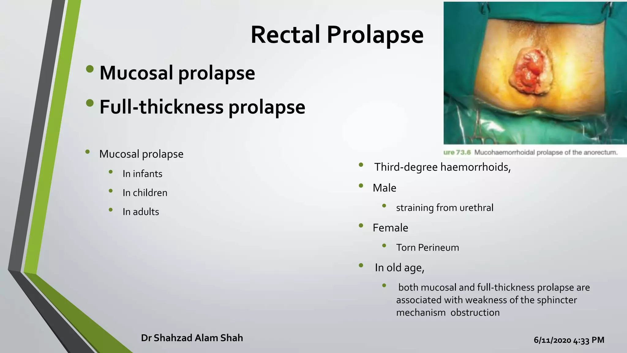 Rectal Prolapse | PPT
