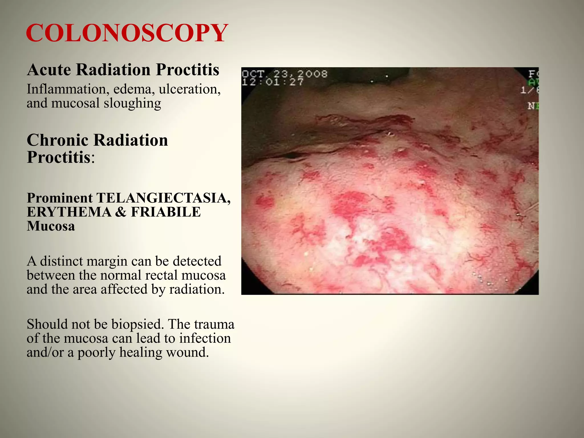 Radiation induced Rectal morbidity | PPTX