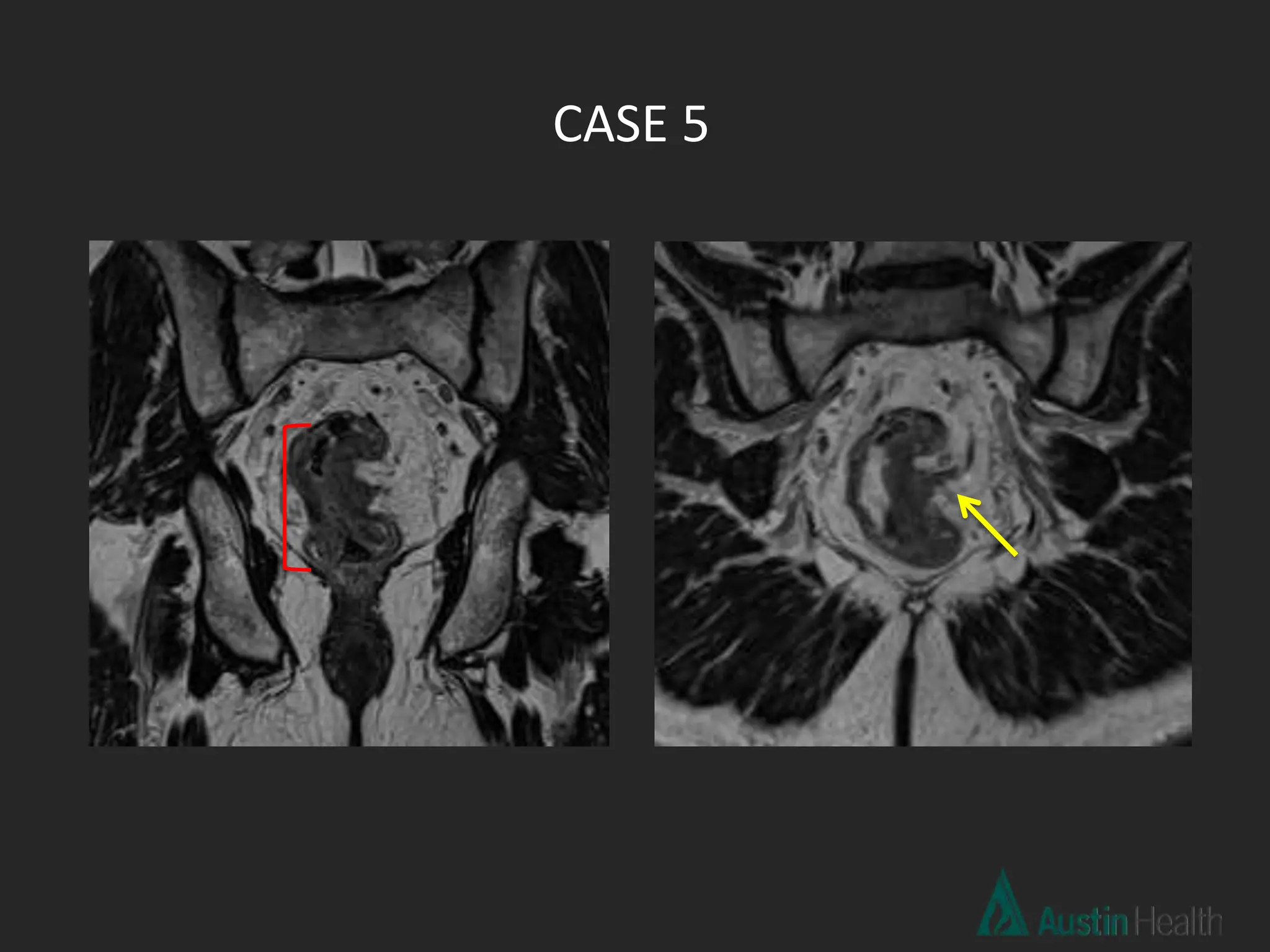 Rectal MRI .pptx