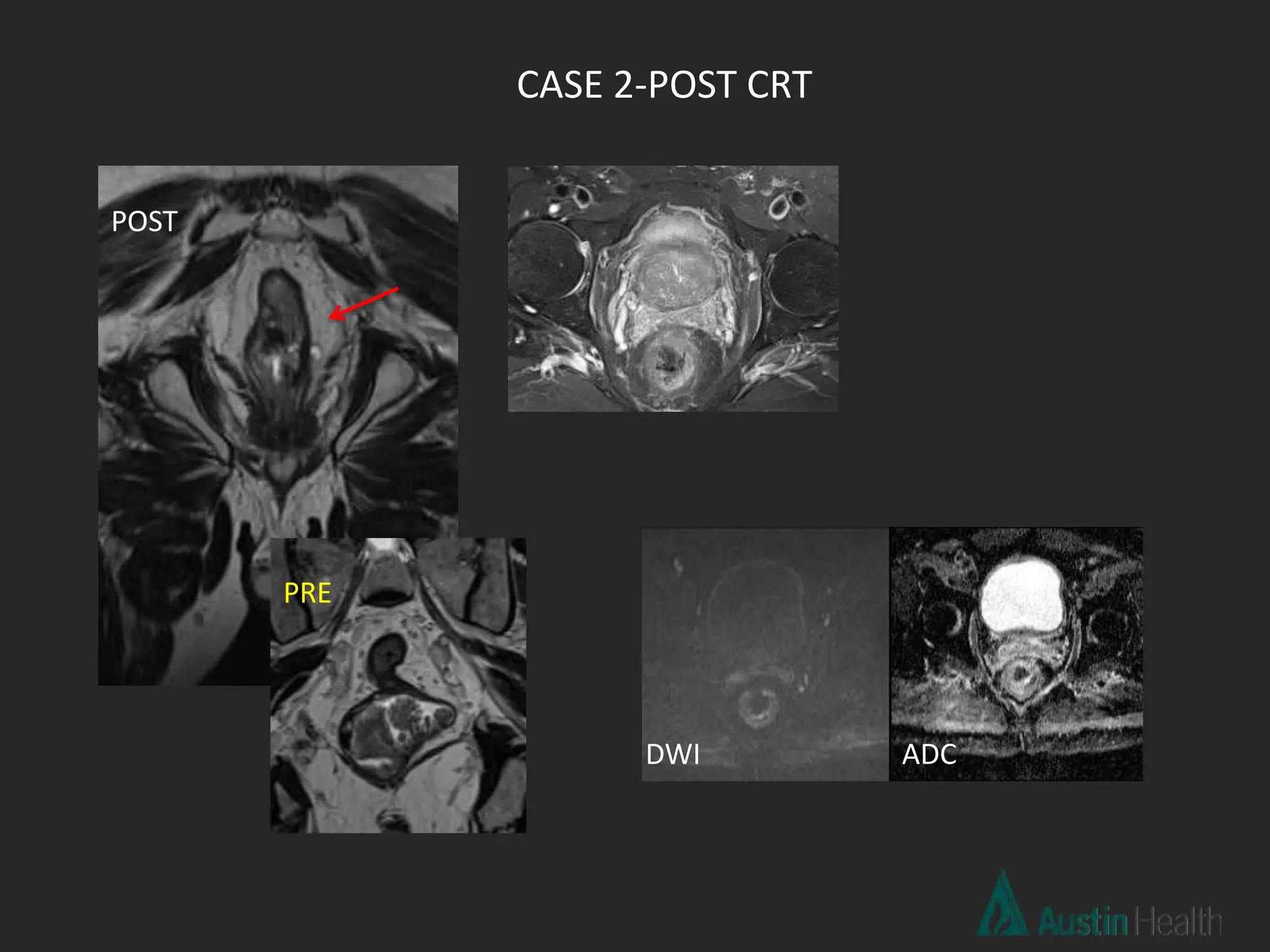 Rectal MRI .pptx